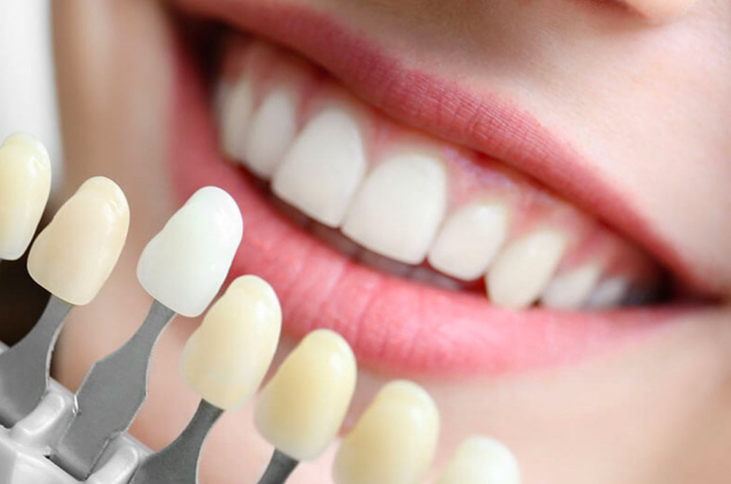 Faccette dentali - Studio Dentistico Marina Fiocca Faccette dentali - Studio Dentistico Marina Fiocca